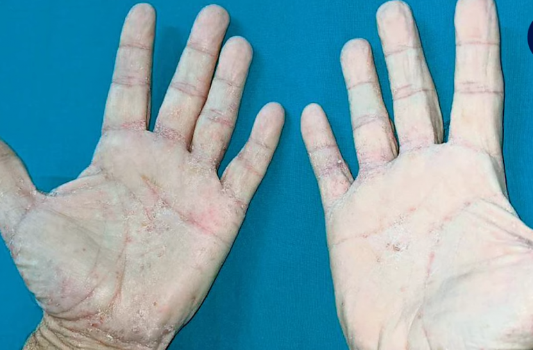 Detectan más de una veintena de casos de lepra en Santiago de Cuba