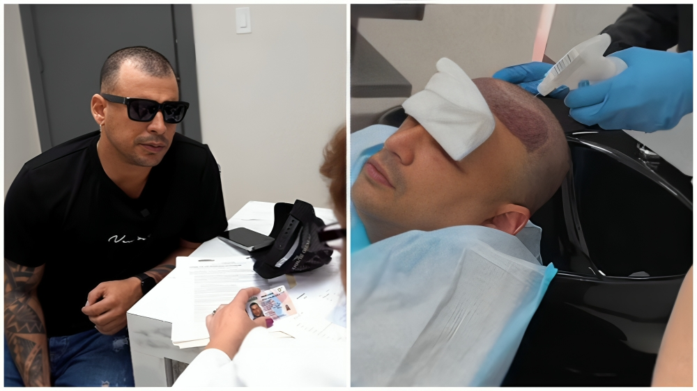 ¡Así le quedó la cara a Ultrack después de su implante capilar!