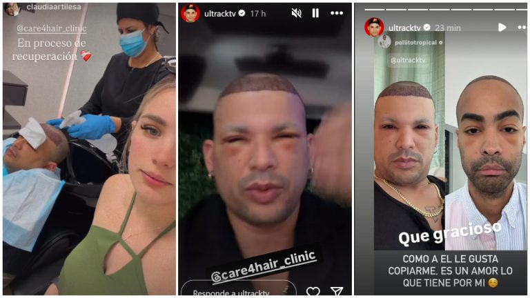 ¡Así le quedó la cara a Ultrack después de su implante capilar!